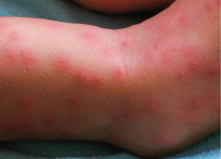 Puces : prévention et lutte raisonnée - Connen